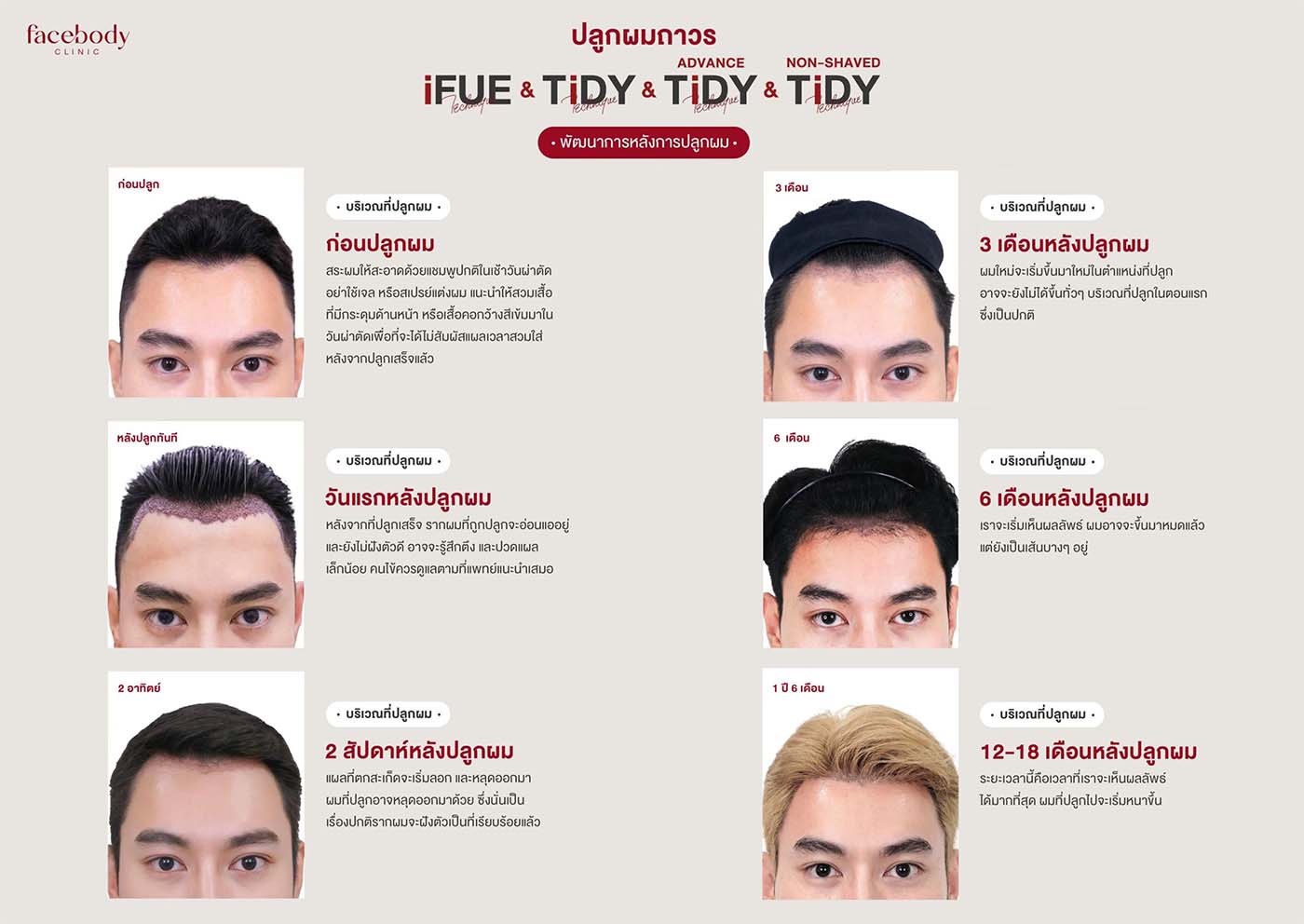 ปลูกผมกรุงเทพ ดีไหม อธิบายเทคนิค FUE วิธีเลือกคลินิกที่ได้มาตรฐาน
