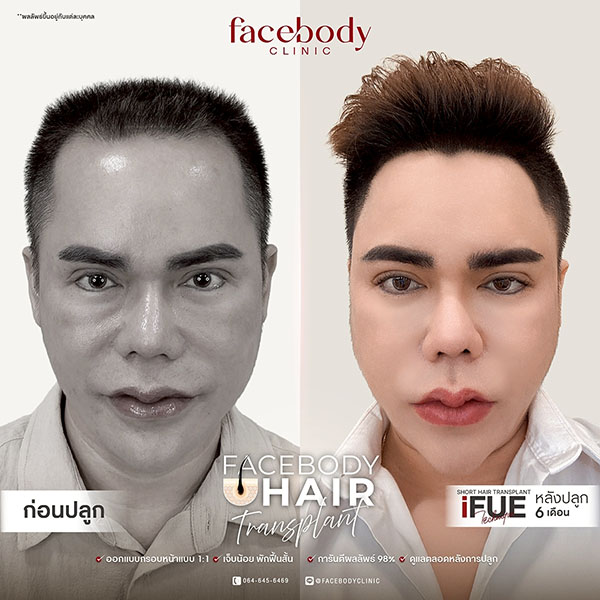 ปลูกผม FUE คือ การแก้ปัญหาผมบางศรีษะล้านเทคนิคทันสมัยสุดปี 2026